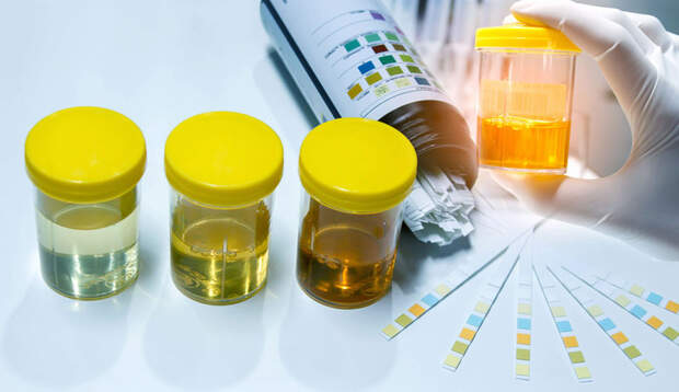 Urinfarbe: Bedeutung für die Gesundheit | MEN'S HEALTH