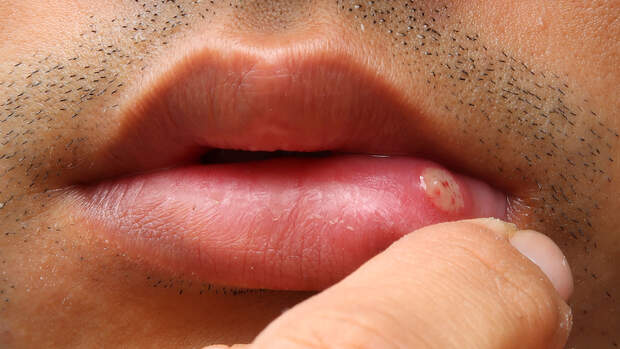 Aphthen im Mund: 5 hilfreiche Tipps - MEN'S HEALTH