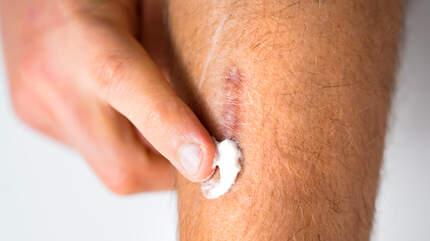 Narben pflegen: So werden sie unsichtbar