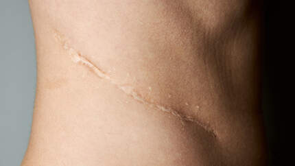 Narben pflegen: So werden sie unsichtbar | MEN'S HEALTH