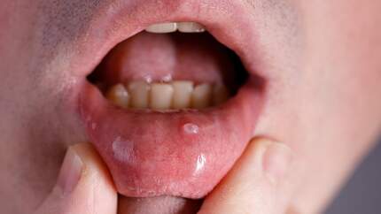 Aphthen im Mund: 5 hilfreiche Tipps | MEN'S HEALTH